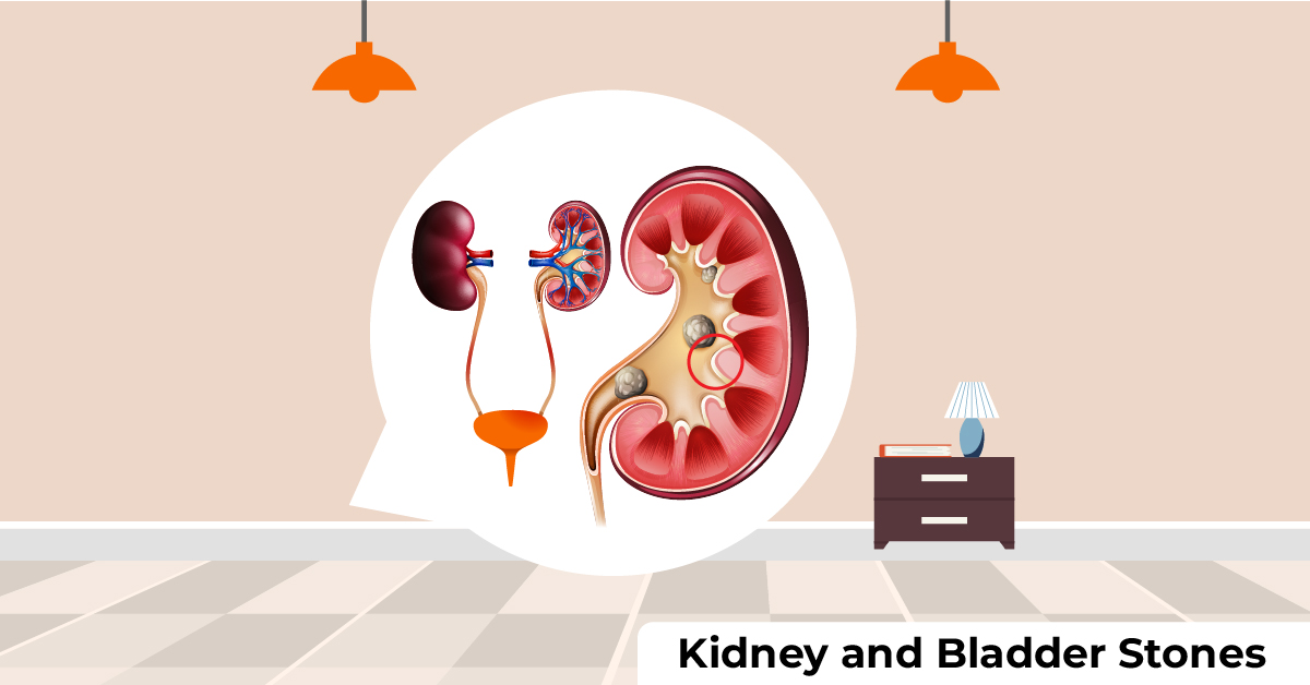 Kidney And Bladder Stones